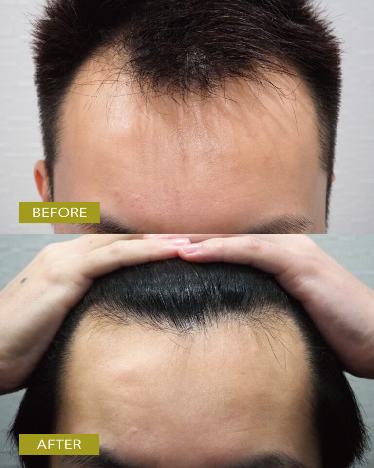 大阪AGA加藤クリニック 梅田 難波 PRP療法 薄毛治療 注入治療 AGA内服薬